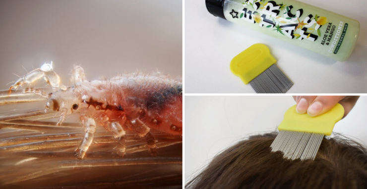 How To Get Rid Of Nits (Head Lice Treatments That ACTUALLY Work ...