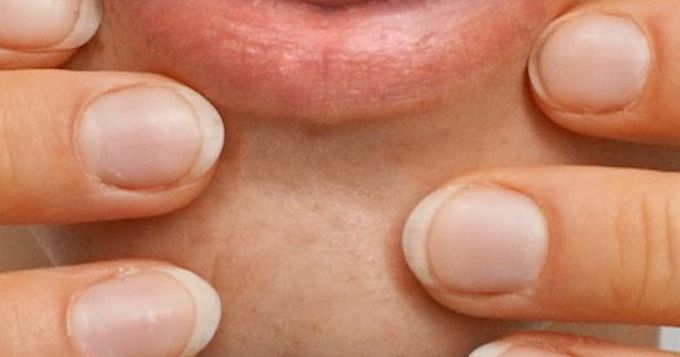 What Causes Spots? How To Prevent & Treat A Breakout - Expert Home Tips